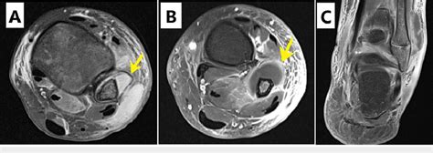 Magnetic Resonance Imaging Mri Of The Left Ankle A Axial Proton