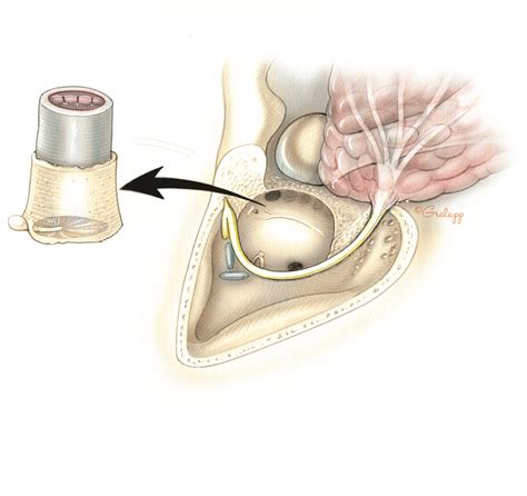 Lateral Temporal Bone Resection Oto Surgery Atlas