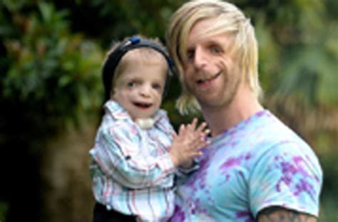 Treacher Collins Syndrome