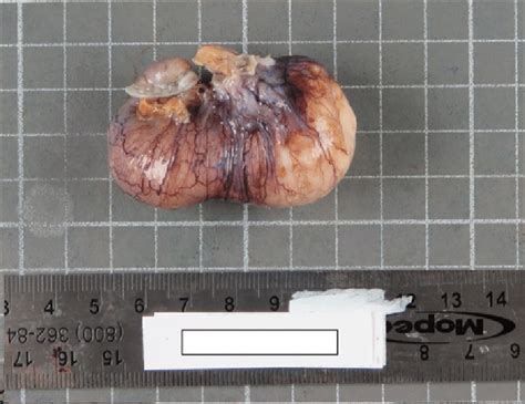 The Gross Resected Appendix With Mesoappendix Demonstrating Dilatation Download Scientific