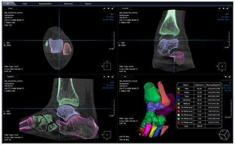 Weight Bearing Ct For Diseases Around The Ankle Joint