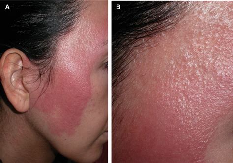 Contact Dermatitis Face