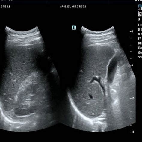 Postoperative Re Examination Images Ultrasound Examination Indicates