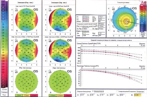Laser Interferometry Pachymetry At Pearl Murray Blog