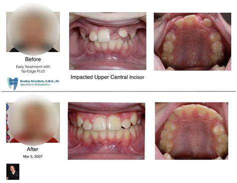 Impacted Front Teeth