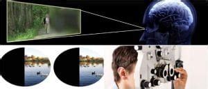 Hemianopsia Definición Tipos Causas Síntomas Diagnóstico Y Tratamiento
