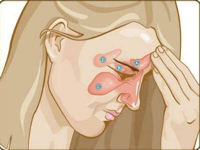 Diferen As Entre Rinite E Sinusite