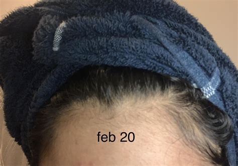 2 Month Minoxidil Hairline Results Rminoxidil