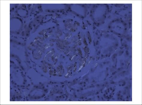 Glomerular Amyloid Deposits With Apple Green Birefringence When Viewed