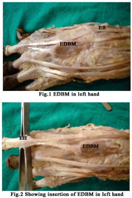 Extensor Indicis Cadaver
