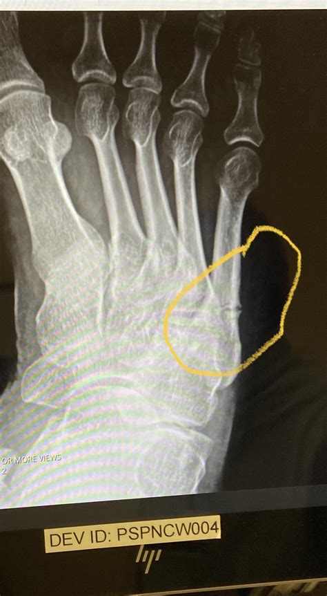 Jones Fracture R Brokenbones
