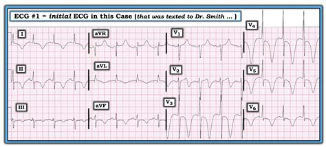Dr Smiths Ecg Blog Diffuse T Wave Inversions And A Very Long Qt
