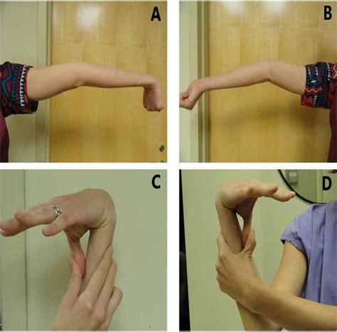The Diagnosis Of Benign Joint Hypermobility Syndrome In Two Female