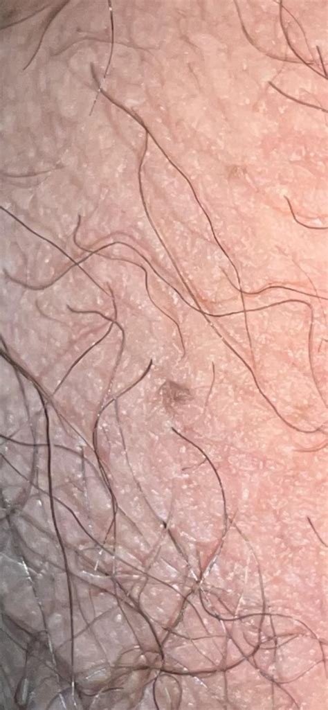 New Dark Spot On Scrotum Is It Cancer Rdermatologyquestions
