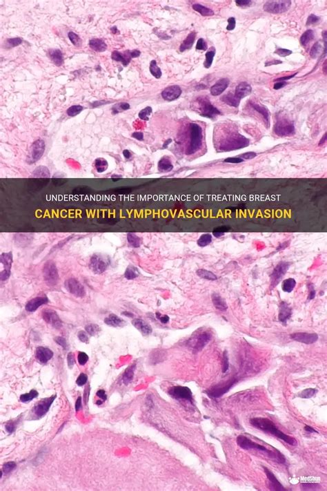 Understanding The Importance Of Treating Breast Cancer With