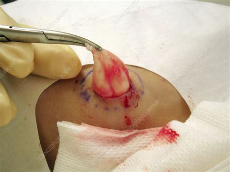 Cyst Removal Stock Image C061 2618 Science Photo Library