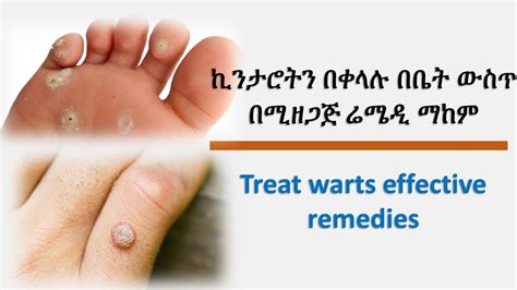ኪንታሮትን በቀላሉ ማከም Treat Warts Effective Remedies Youtube