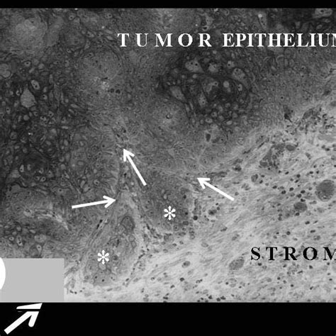 An Overview Of A Scc Tumor Stroma Interface While Tumor Mass Strands