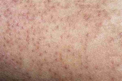 Gotucream 1 Fl Oz 30ml Organic Keratosis Pilaris Treatment Cream