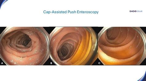 New Technique Cap Assisted Push Enteroscopy For Upper Jejunal Bleeding