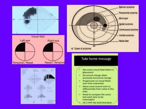 Visual Field Analysis Interpretation