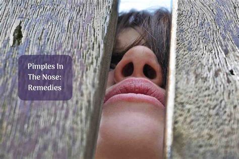 Pimple In The Nose Here S How You Can Fix The Problem