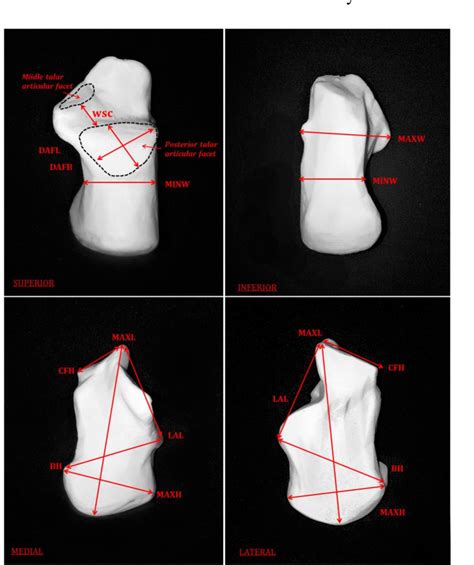 Figure 1 From Sexual Dimorphism Of The Calcaneus In Contemporary