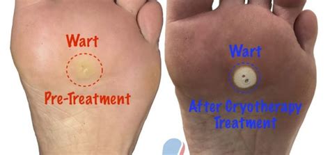 Verruca Plantaris Treatment