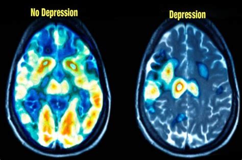 Brain Scan Depression