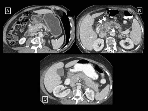 Radiología De La Pancreatitis Aguda Hoy Clasificación De Atlanta Y