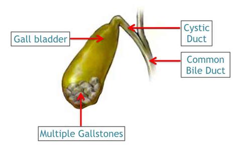 Gallbladder Stones Treatment Clinic Laparoscopic Gallbladder Surgery
