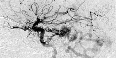 Principles Of Dural Arteriovenous Fistula Surgery The Neurosurgical Atlas By Aaron Cohen