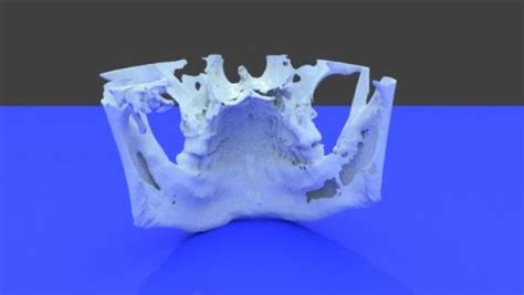 Dentistry Stl File Processed Dental Orthodontic Maxillofacial