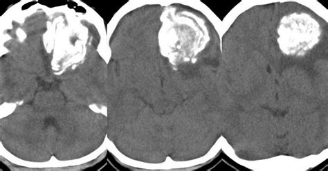 Dr Balaji Anvekar Frcr Dense Calcified Involuted Sclerotic Psammomatous Meningioma Mri