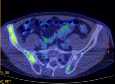 In The Case 1 Multiple Bone Metastases Were Suspected By A Positron