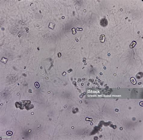 Imagen Microscópica Que Muestra Cristales De Oxalato De Calcio De