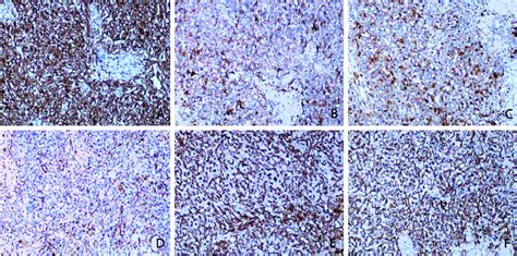 Immunohistochemical Staining A Vimentin Staining Diffuse And Strong