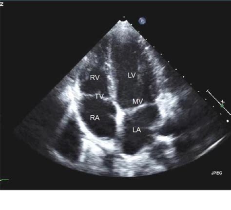 Cardiac Imaging Non Invasive Flashcards Quizlet