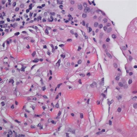 Hematoxylin And Eosin Stain ×40 Shows Normal Glomerulus In Size And
