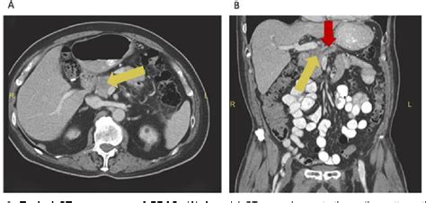 Figure 2 From Pancreatic Ductal Adenocarcinoma Semantic Scholar