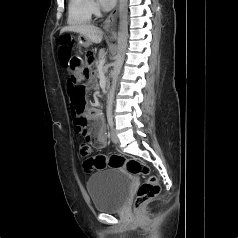 Filetransmesenteric Internal Hernia Duodenal Switch Radiopaedia