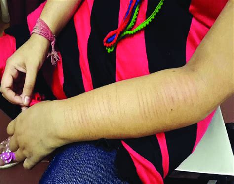 Scratch Marks