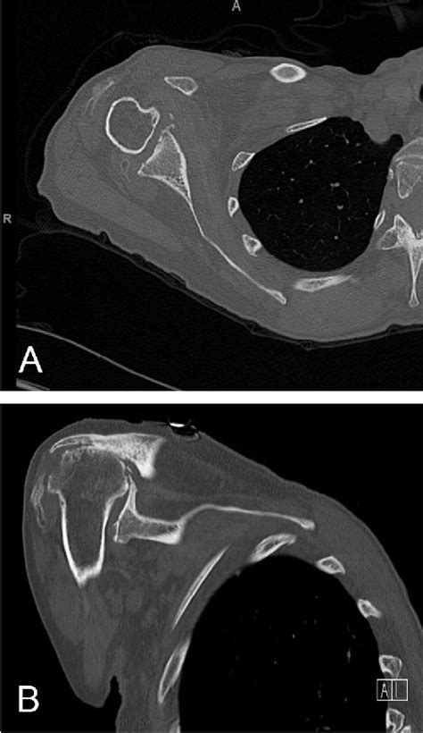 Figure 1 From Structural Glenoid Grafting During Primary Reverse Total Shoulder Arthroplasty