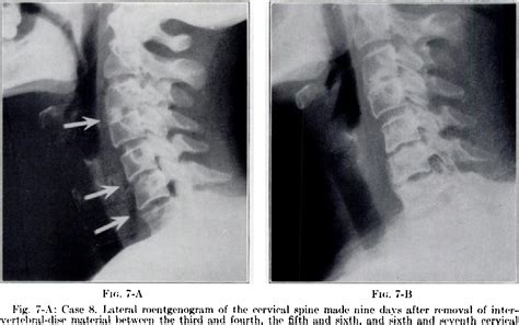 Intervertebral Disc Structure Semantic Scholar