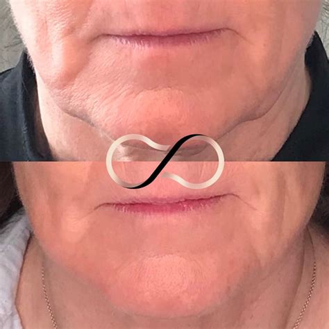 Aesthetics Clinic In Wirral And Heswall Cosmetic Perfection