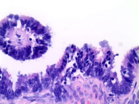 Serous Cystadenoma Histology