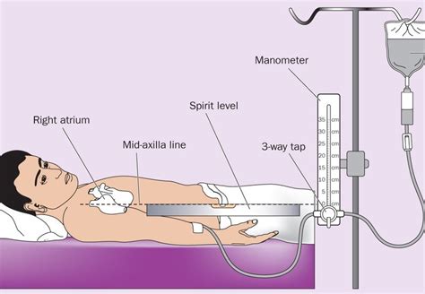 Đo Cvp Là Gì Quy Trình Thực Hiện đo Cvp Không Phải Ai Cũng Biết Sống