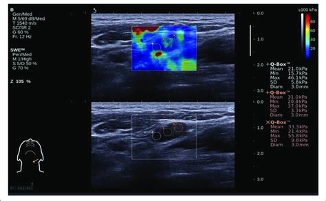 Shear Wave Elastography Evaluation Of A Metastatic Small Cervical