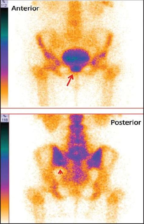 Technetium 99m Methylene Diphosphonate Bone Scintigraphy Arrow In