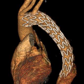 Postoperative Three Dimensional Computed Tomography Images Of Case 1